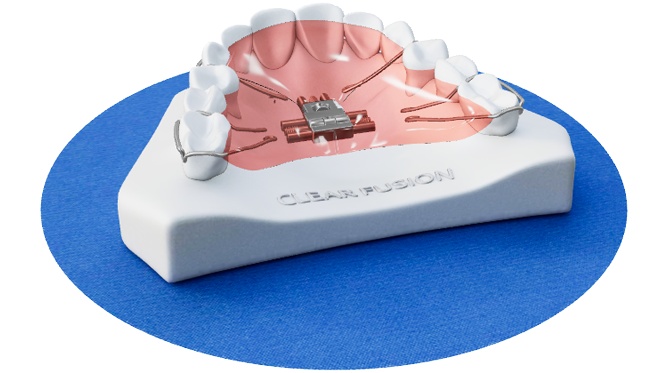 3 Way Expander - Clear Fusion