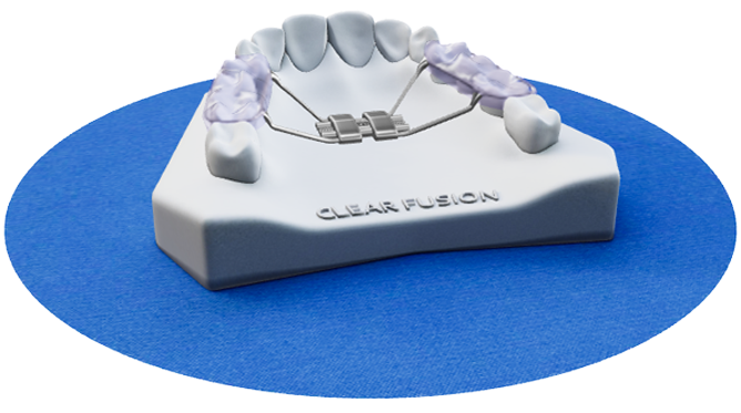 Bonded RPE - Clear Fusion